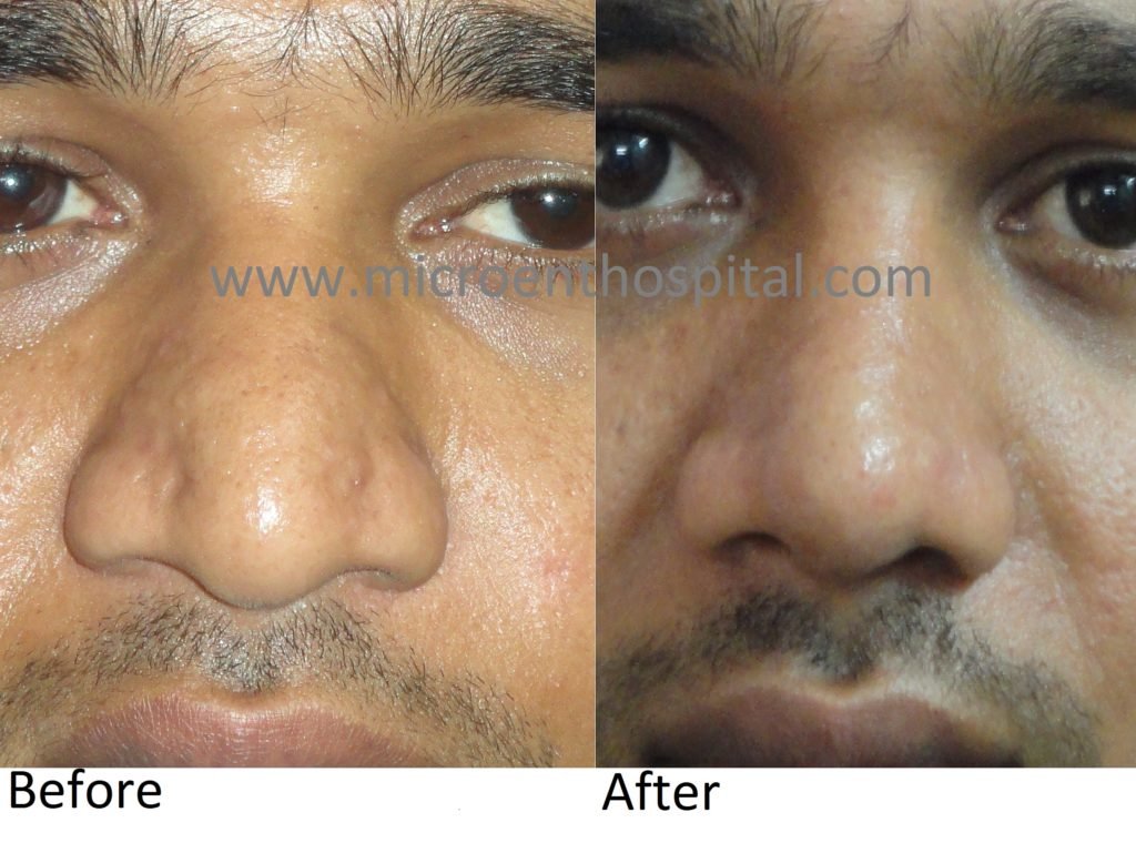 Broad Nose Correction Rhinoplasty in Hyderabad | Broad Nose Correction