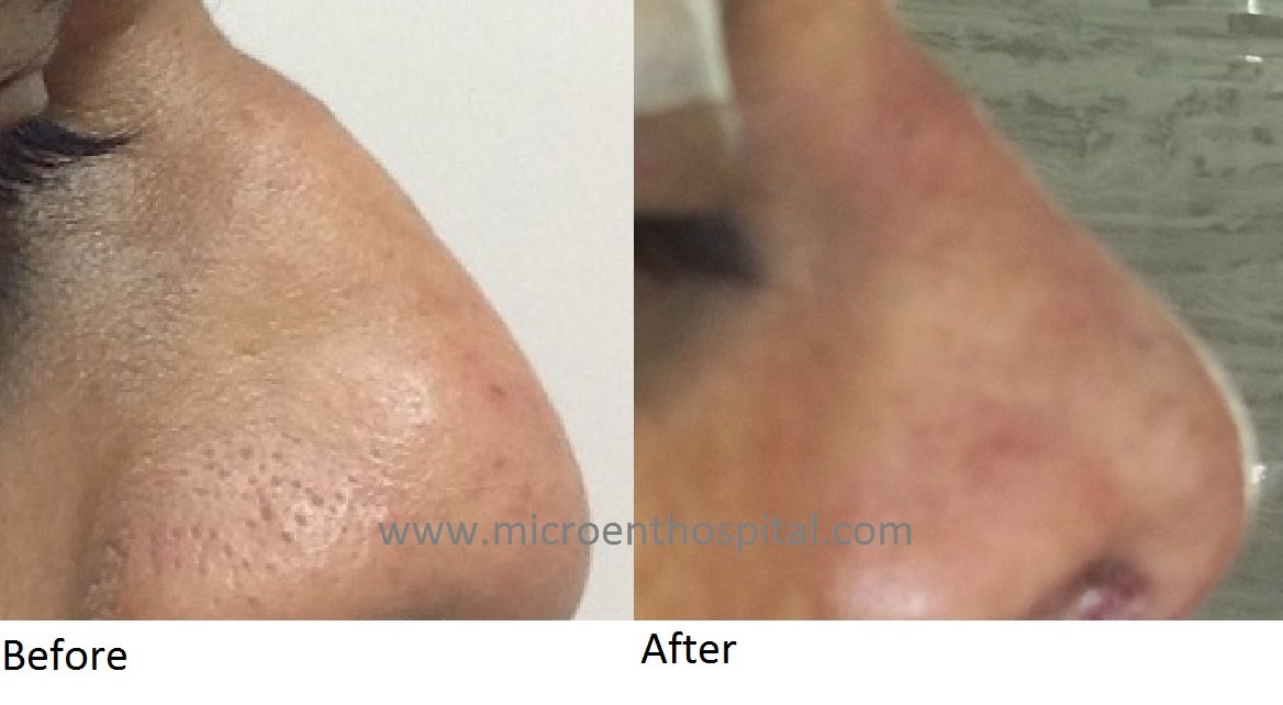 Before After Pictures Welcome To Microcare Rhinoplasty Centre In